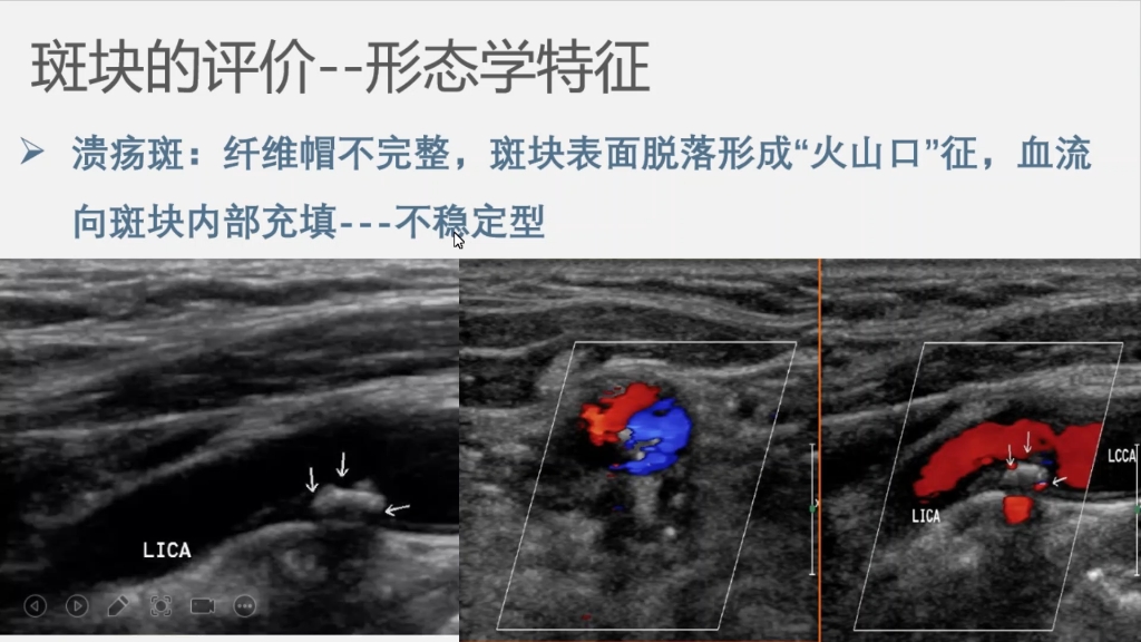 血管超声:颈部血管超声解剖及扫查手法演示