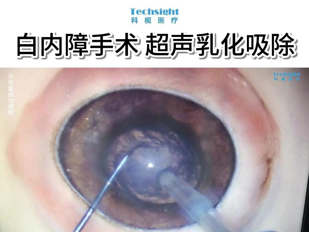 白内障手术过程——超声乳化吸除