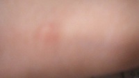 去除疤痕 凸起疤痕 修复疤痕