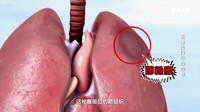 动画演示肺栓塞形成过程