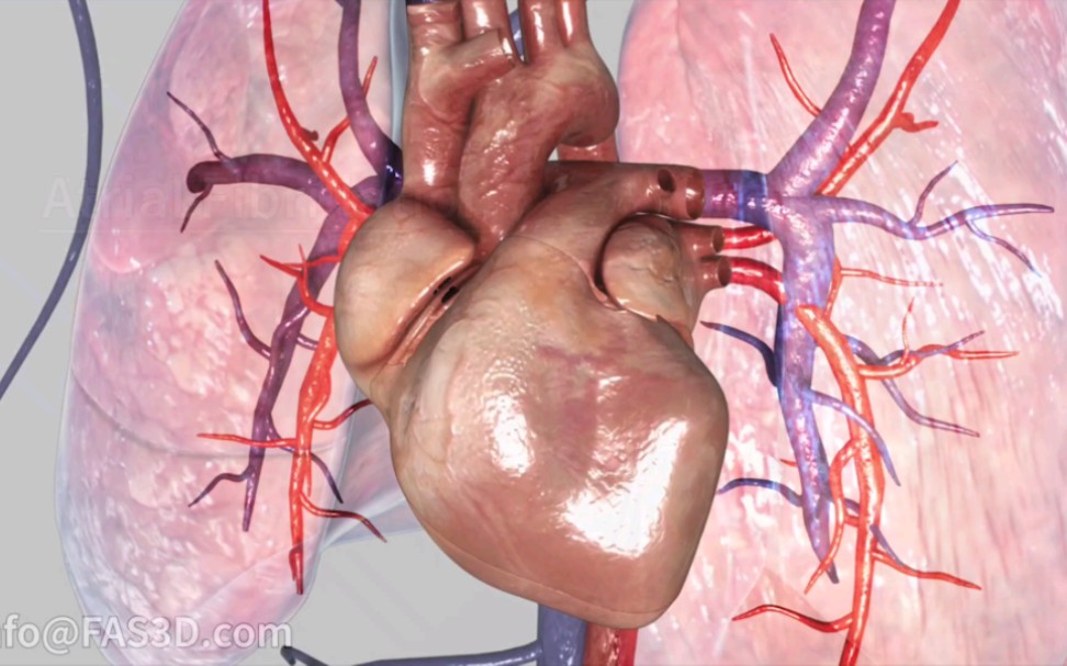 心脏房颤导致脑梗塞原因,3D演示。