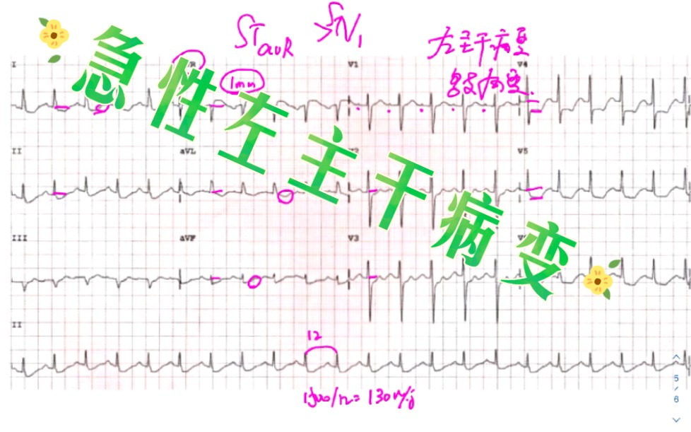 ...多导联st强烈提示冠状动脉左主干(LMCA)闭塞或严重多支血管病变。