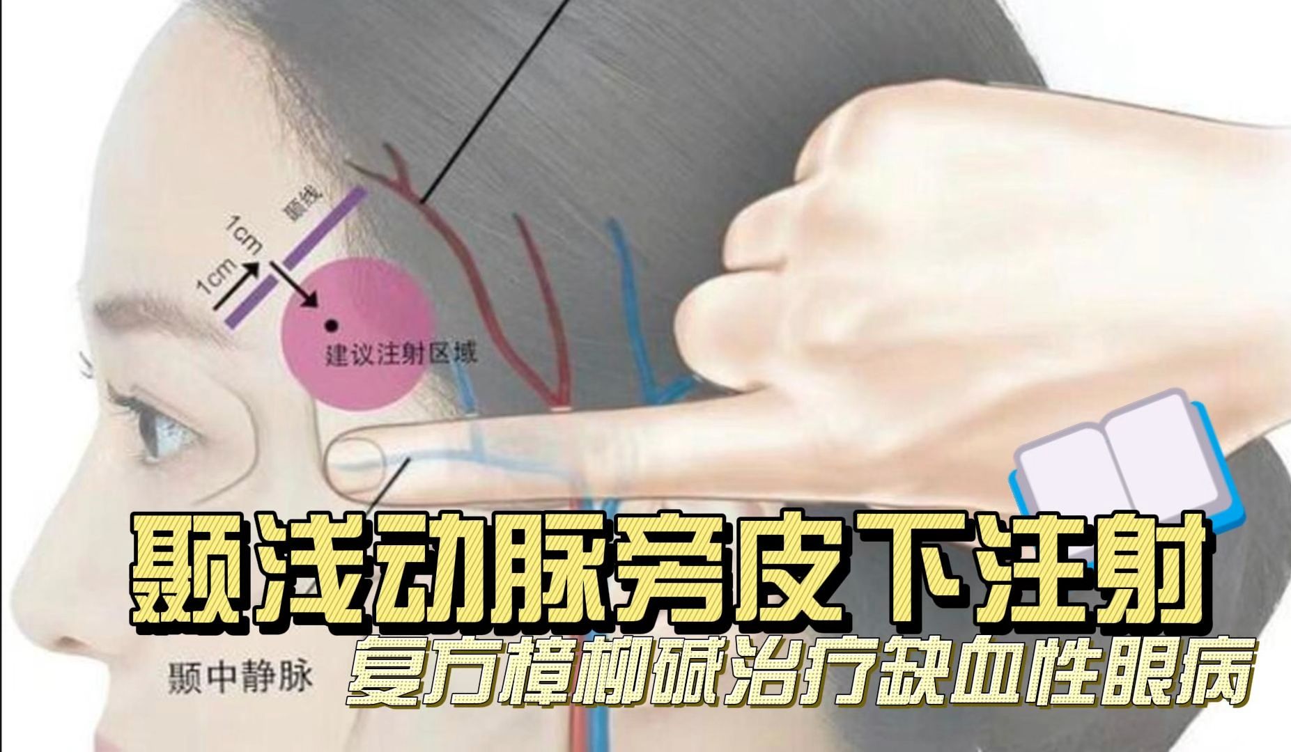 【颞浅动脉旁皮下注射】复方樟柳碱治疗缺血性眼病