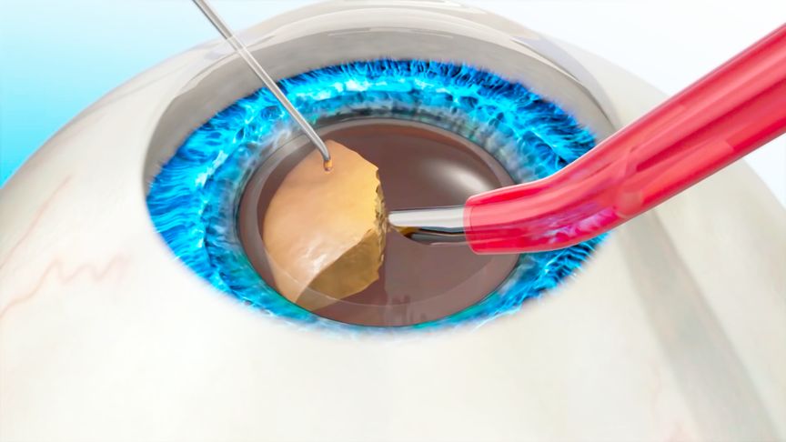 3D动画展示白内障手术过程,了不起的现代医学科技