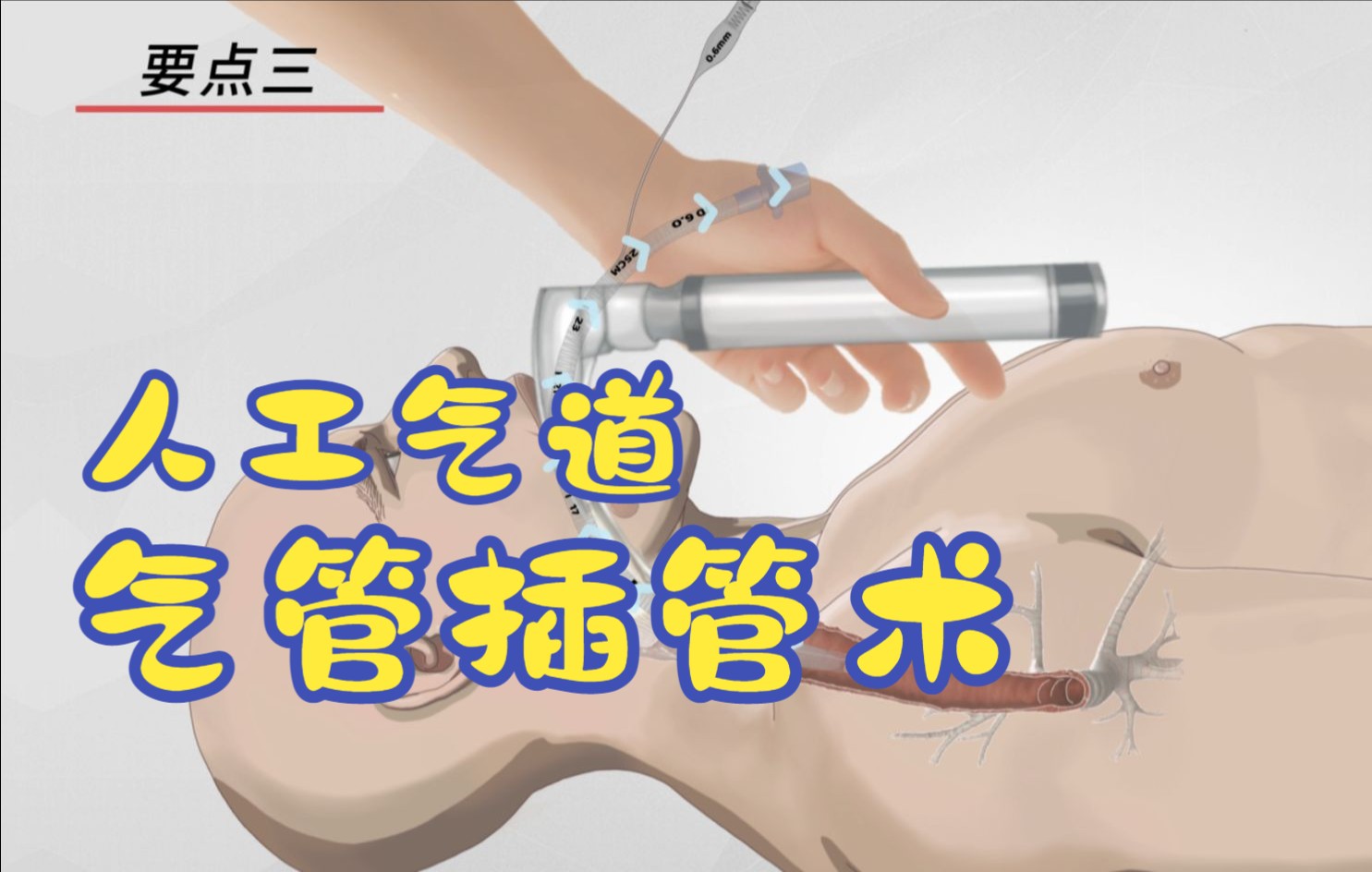 【医识点】--MG动画:气管插管术