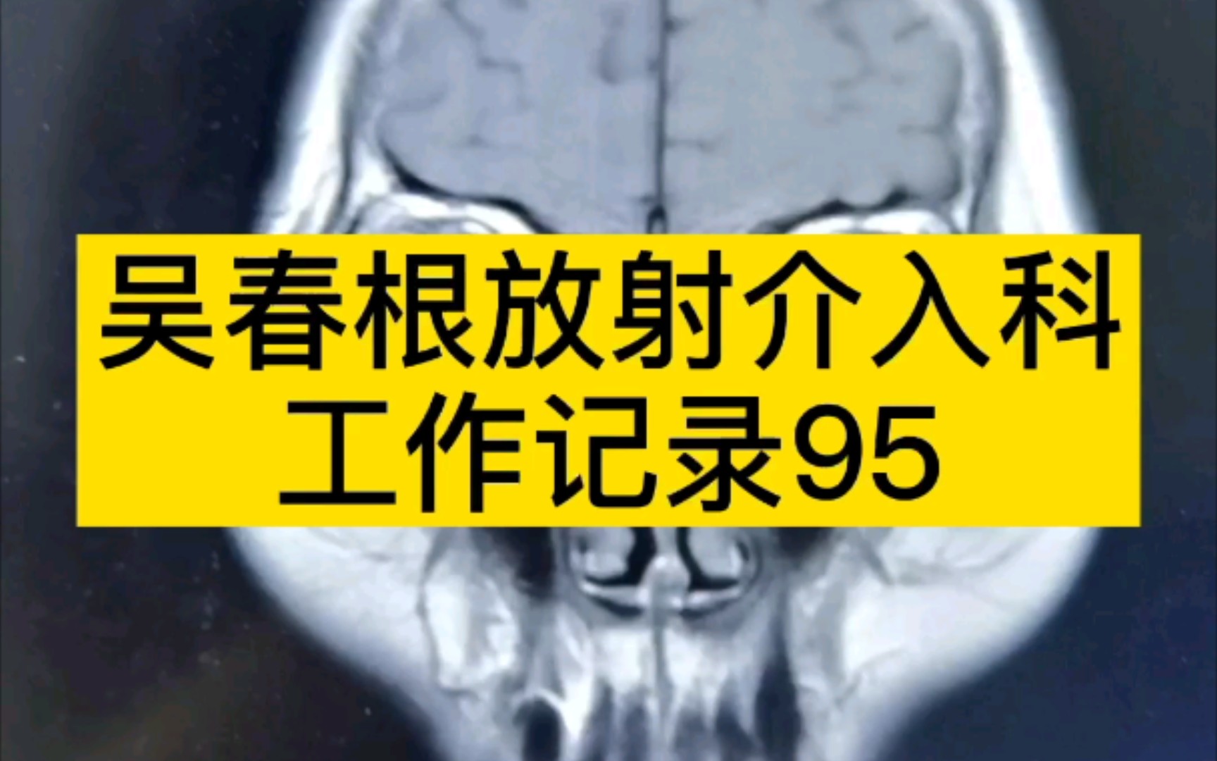 梭形细胞肿瘤,胸骨、髂骨转移,腰椎间盘突出,吴春根介入记录95