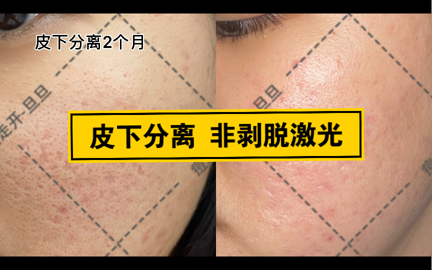 我的去痘坑之路-皮下分离 非剥脱激光