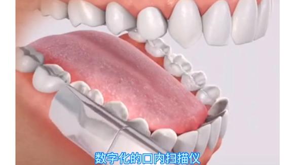 口腔黑科技3D数字化口腔扫描,快速获取口内模型