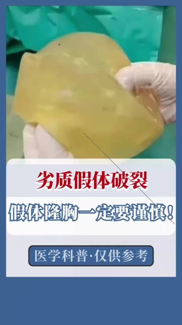 劣质假体破裂,假体隆胸一定要谨慎!