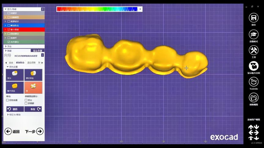 exocad软件舌侧金属带内冠桥设计方法