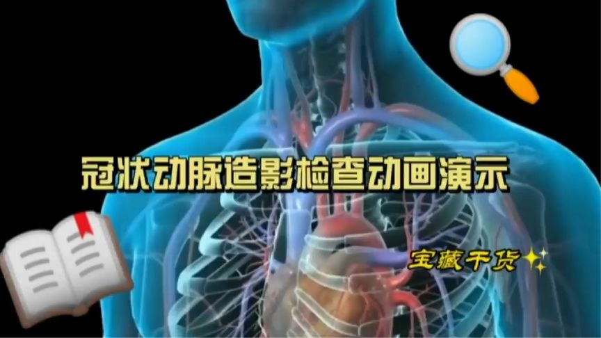 冠状动脉造影动画演示
