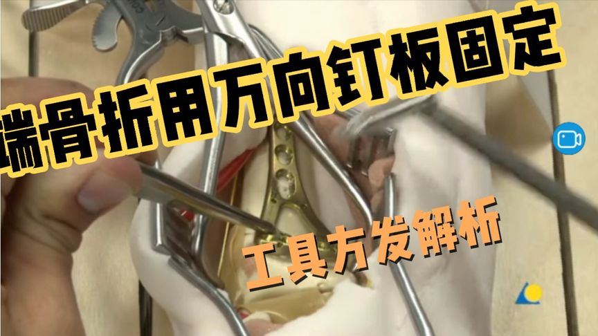 AO桡骨远端钢板骨折复位内固定