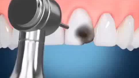 牙齿蛀牙剩牙根如何桩冠修复