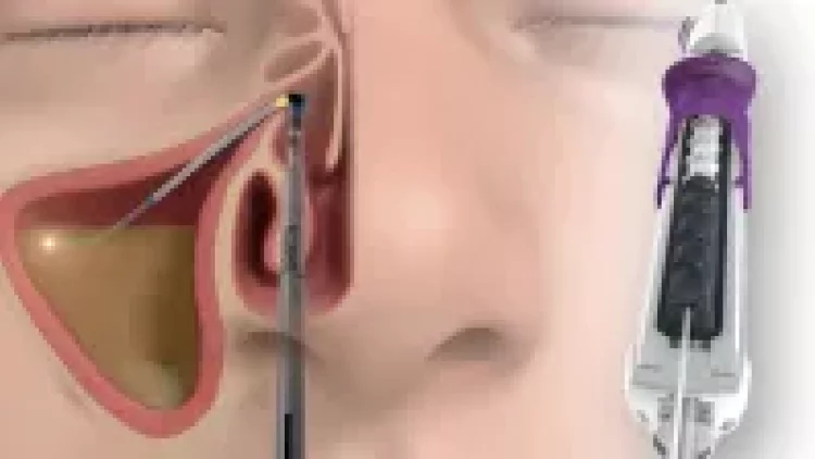 3D模拟最新的医疗器械,能直接插入鼻腔清洗,这太强大了