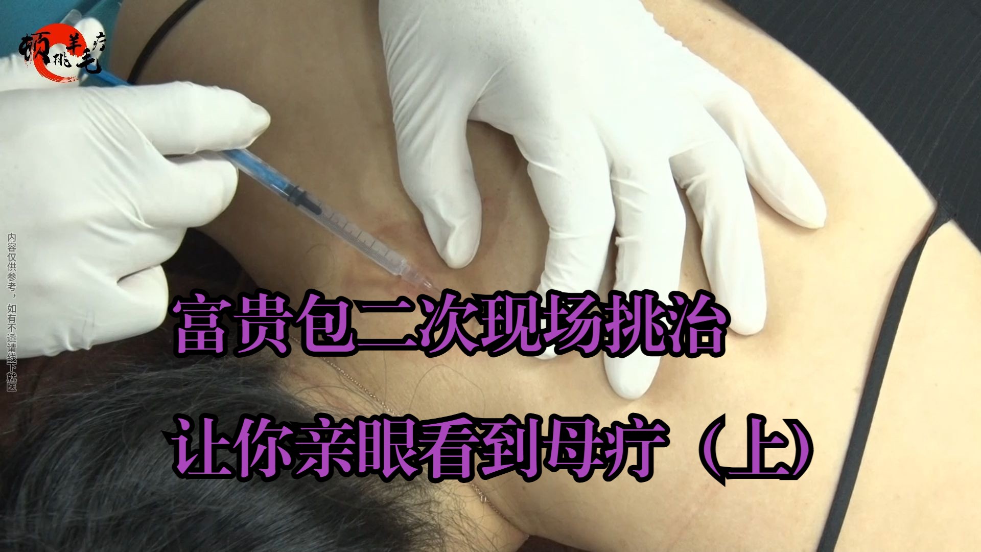 富贵包二次现场挑治,让你亲眼看到母疔(上)