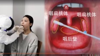 核酸标本鼻咽拭子采集视频