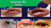 2018.10.10-维生素B2缺乏症简易讲解