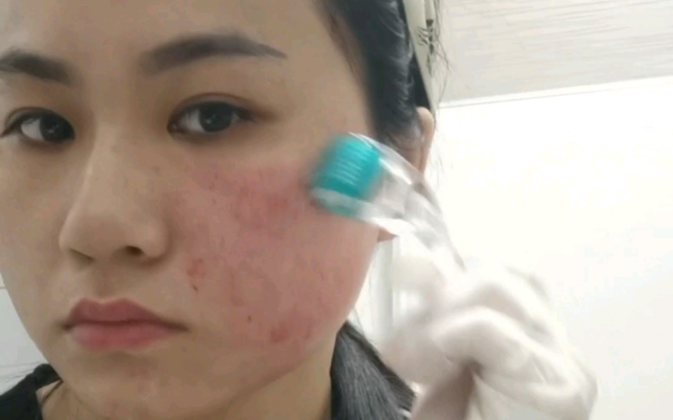 伊肤泉微针操作—伊肤泉赋活美白套组