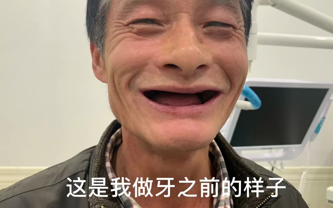 阜阳金阳光口腔医院全口种植牙多少钱?(总部合肥美欧口腔医院)