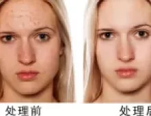 ps人物脸部修复教程