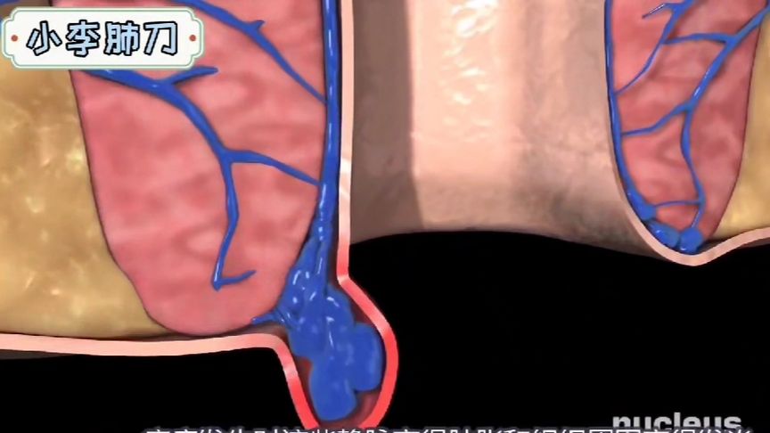看着都疼,痔疮的分类及2种手术方法,3D演示。
