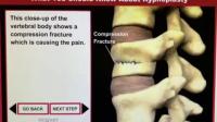 经皮穿刺球囊椎体成形术.mp4