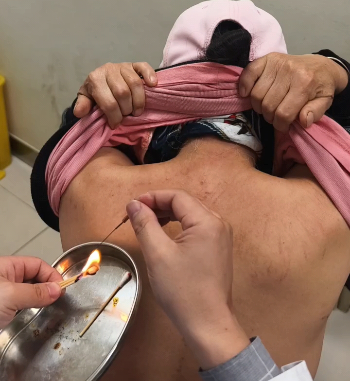 火针疗法—颈、肩、腰、腿痛