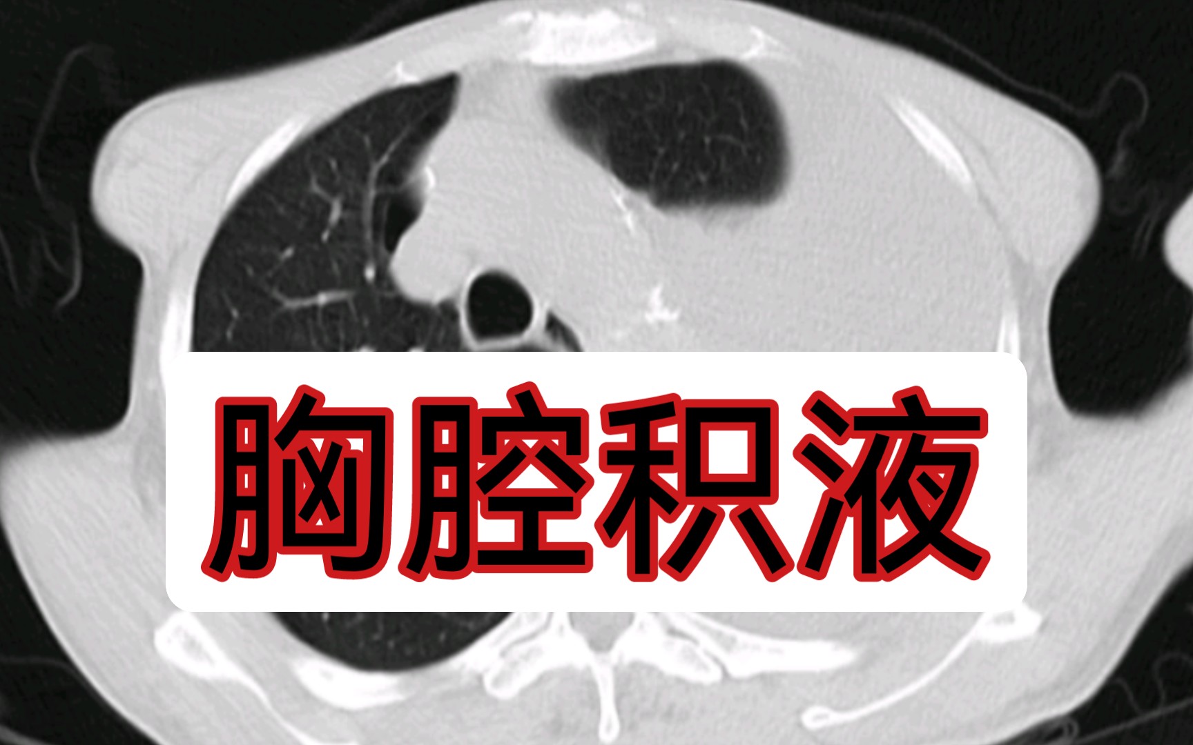 【影像读片】胸腔积液 | CT报告书写 | 基础知识分享