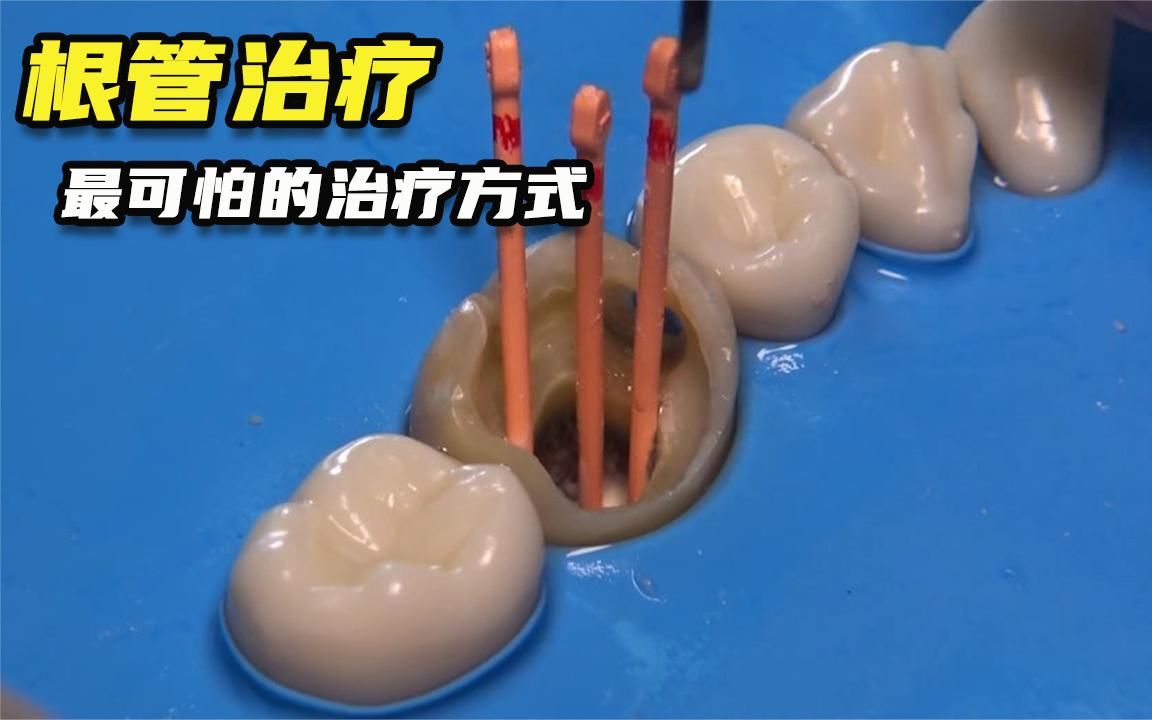 根管治疗到底疼不疼?看完根管治疗全过程告诉你答案