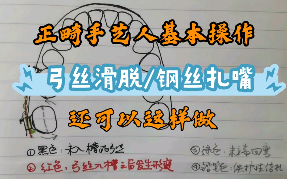 保护性结扎+树脂球/末端回弯,防止弓丝末端滑出颊面管导致的钢丝扎嘴...