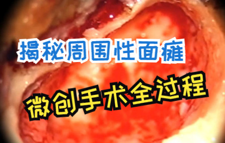 揭秘周围性面瘫微创手术全过程