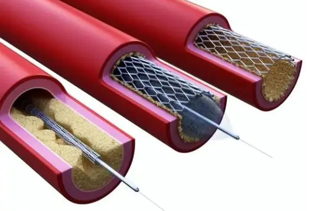 心脏支架/带膜支架等合金型聚合物支架的管径测量