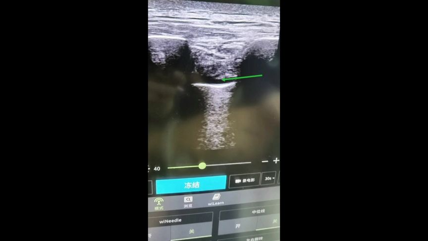 超声引导下椎旁神经阻滞