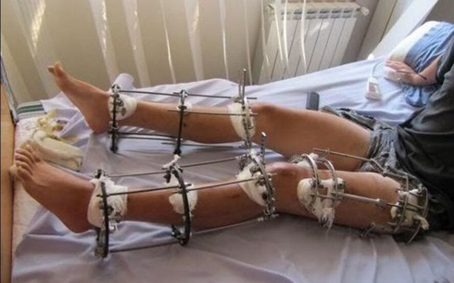 骇人听闻的增高术 为了长高他们把双脚敲断!