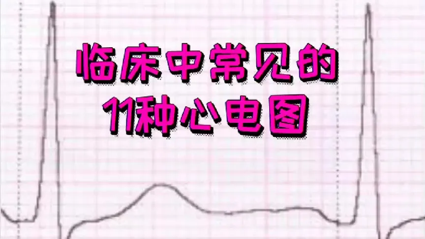 临床中常见的11种心电图