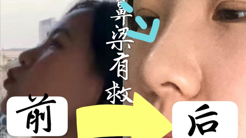 塌鼻梁蒜头鼻的留步,亲试有效不整容七天鼻梁变高的按摩方法来啦