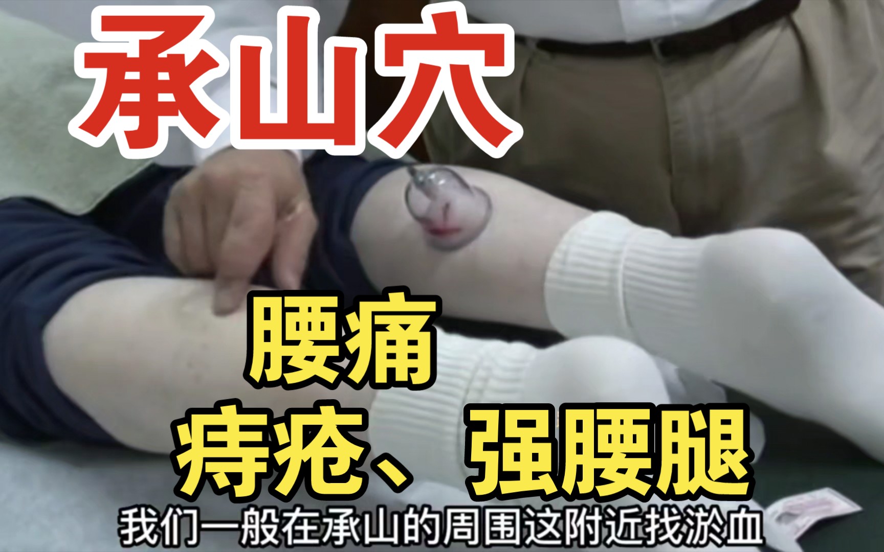 承山穴实操——腰椎疼痛、痔疮治疗,放血治疗都在这。倪师讲针灸