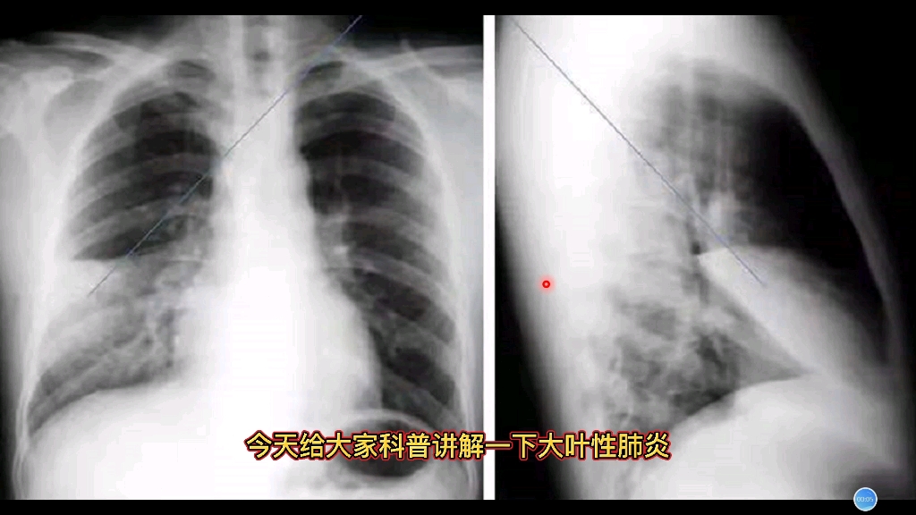 影像知识:胸片典型病例讲解,肺叶在胸片上大致区域划分