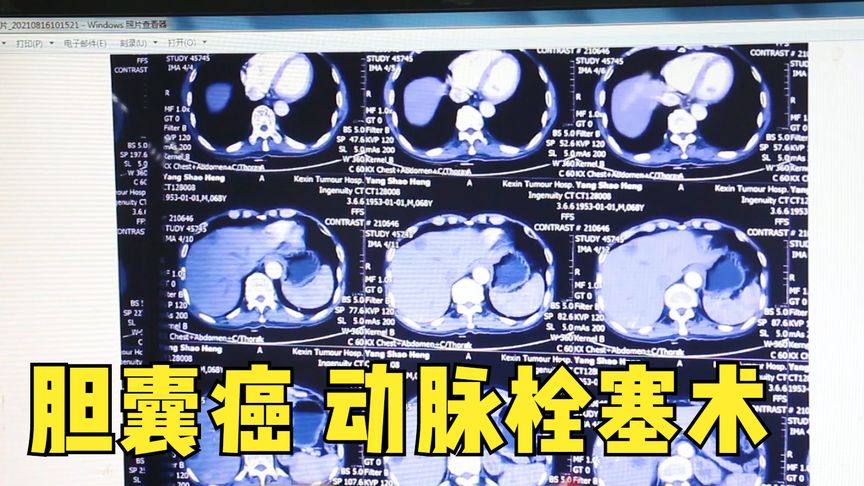 68岁胆囊癌患者,肝脏多发转移,治疗方案:经皮肝动脉化疗栓塞术