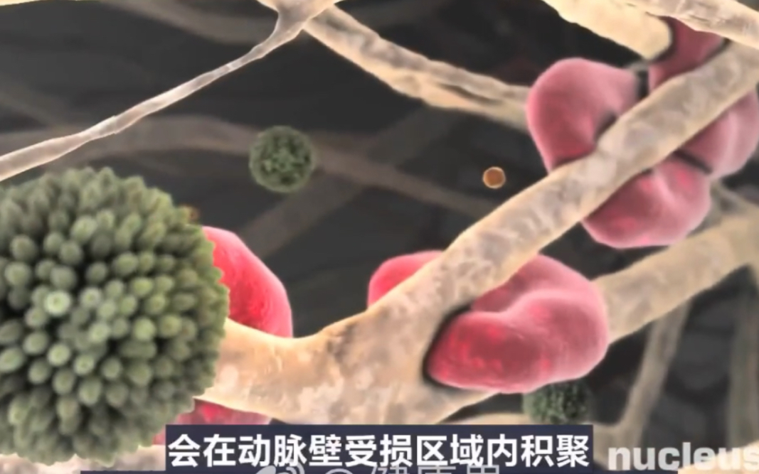 医学科普:更快、更形象的了解动脉粥样硬化!