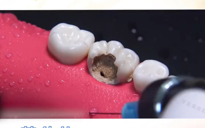 牙疼就需要做根管治疗
