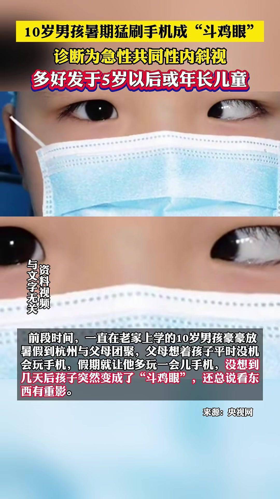 10岁男孩暑假猛刷手机成“斗鸡眼”,诊断为急性共同性内斜视,多好发...