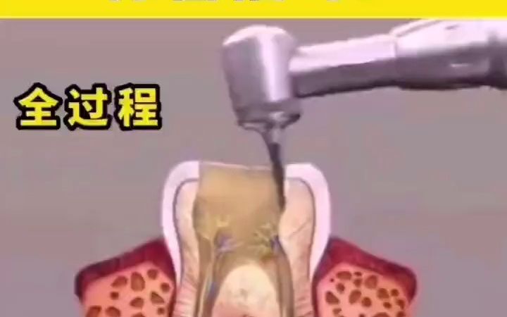 根管治疗的全过程