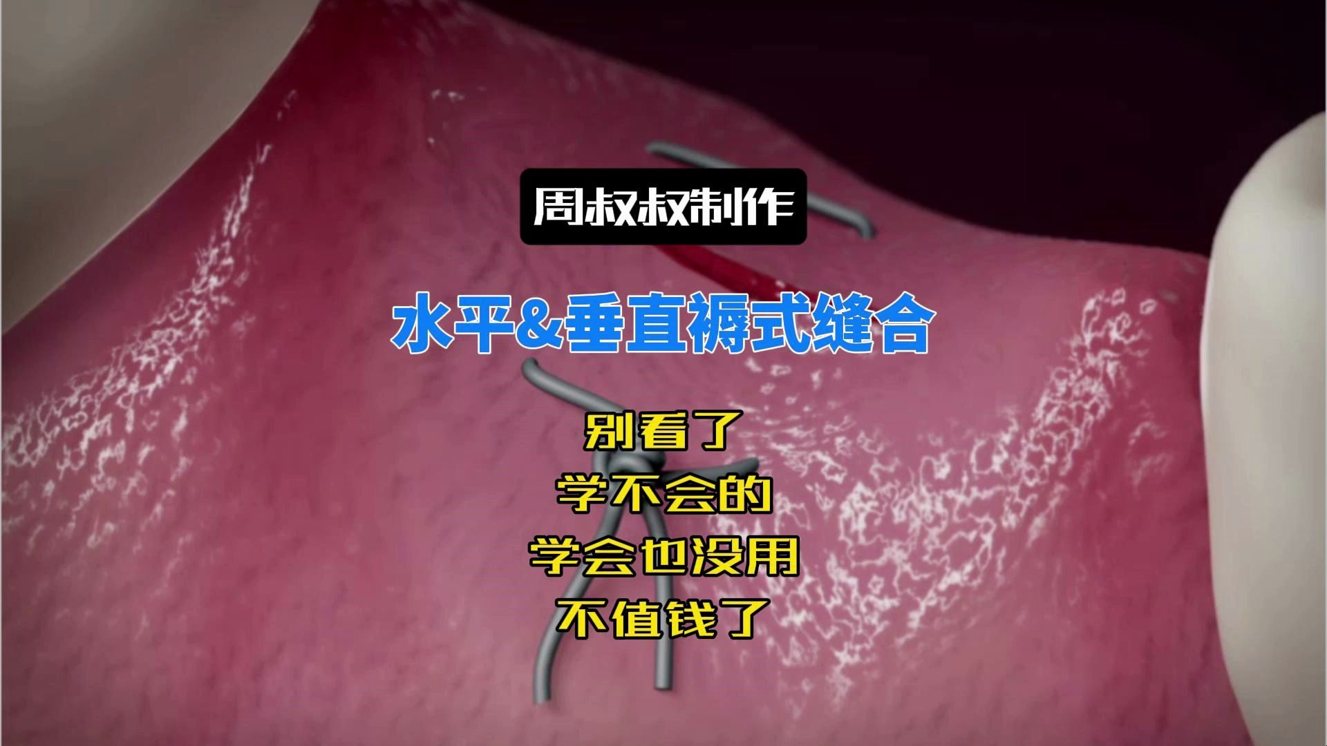 牙科缝合 垂直和水平褥式缝合 包括怎样握持持针器