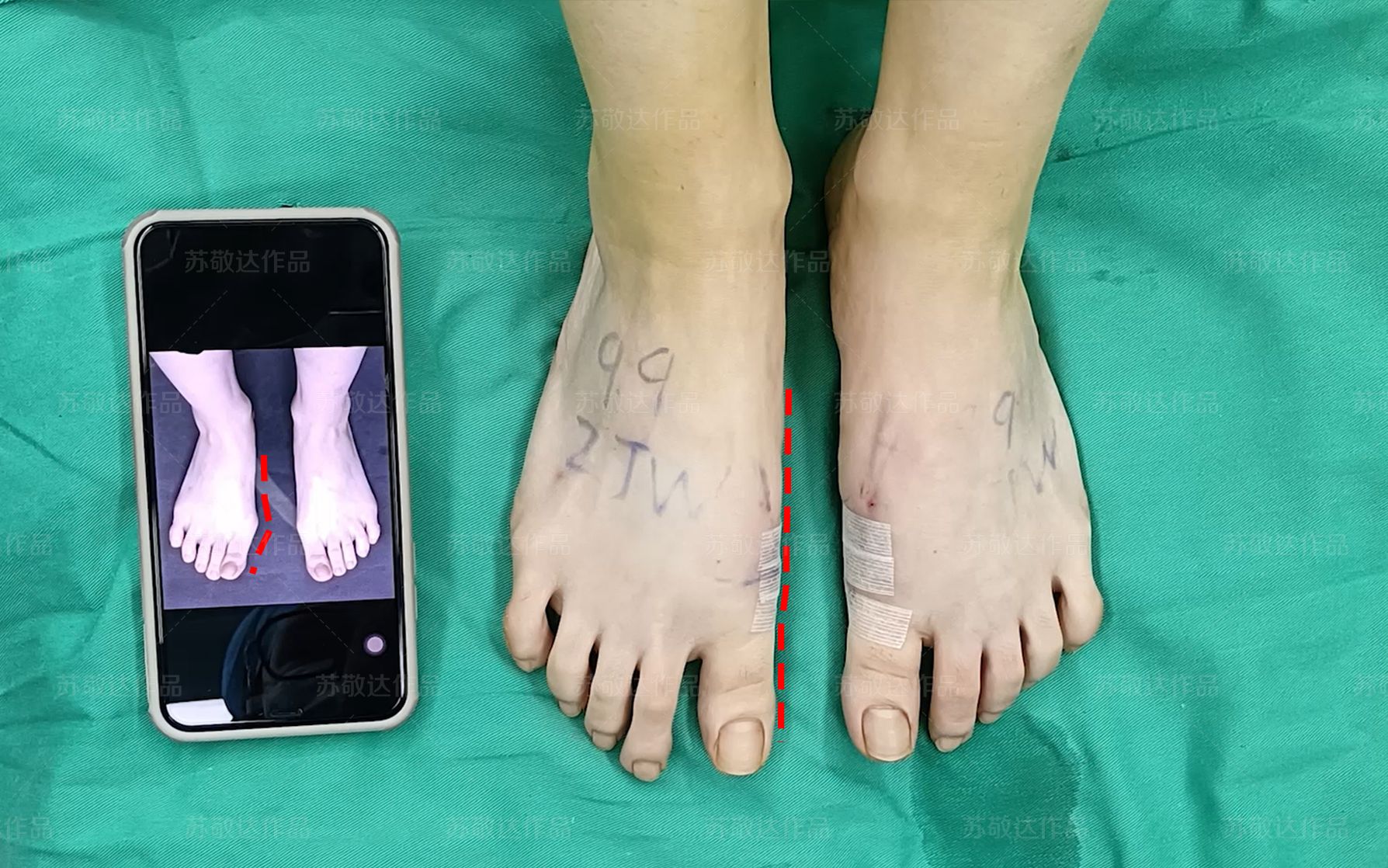 北京苏敬达医生:大脚骨拇外翻手术直播回顾:姑娘全程玩手机,术后脚趾...