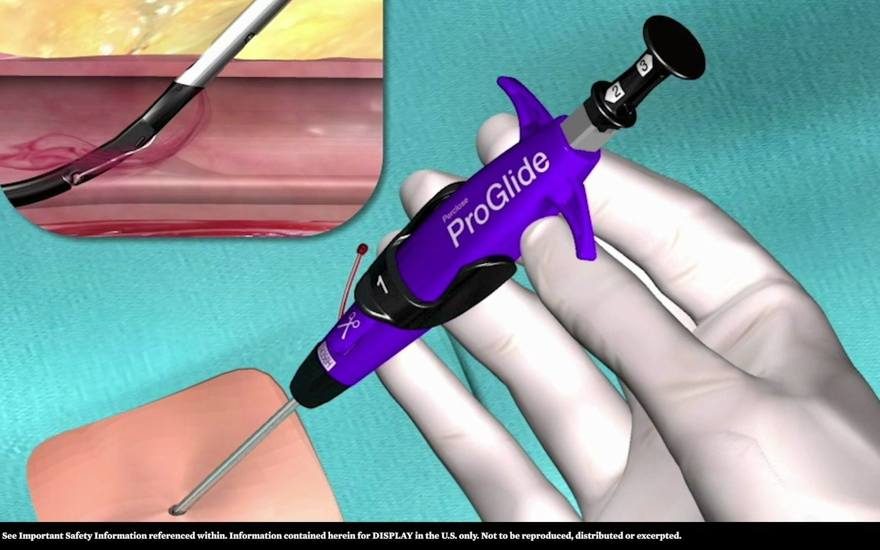 血管闭合装置系列:Perclose ProGlide动画演示,How to Perclose ...