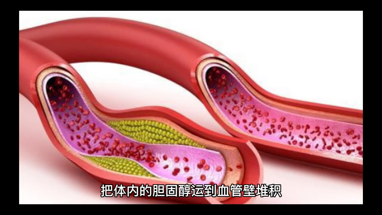 动画演示高血脂对人体心脑血管疾病的危害!