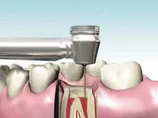缺损过大桩冠修复