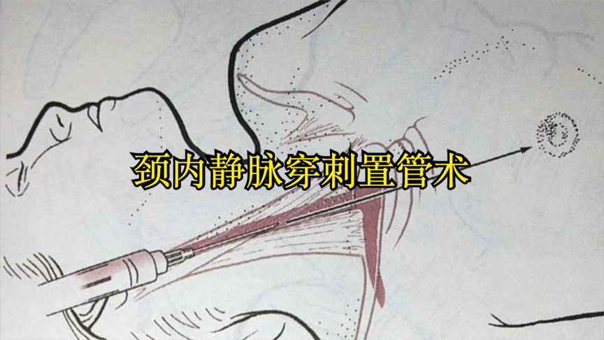 浙江省肿瘤医院麻醉科颈内静脉穿刺置管术演示