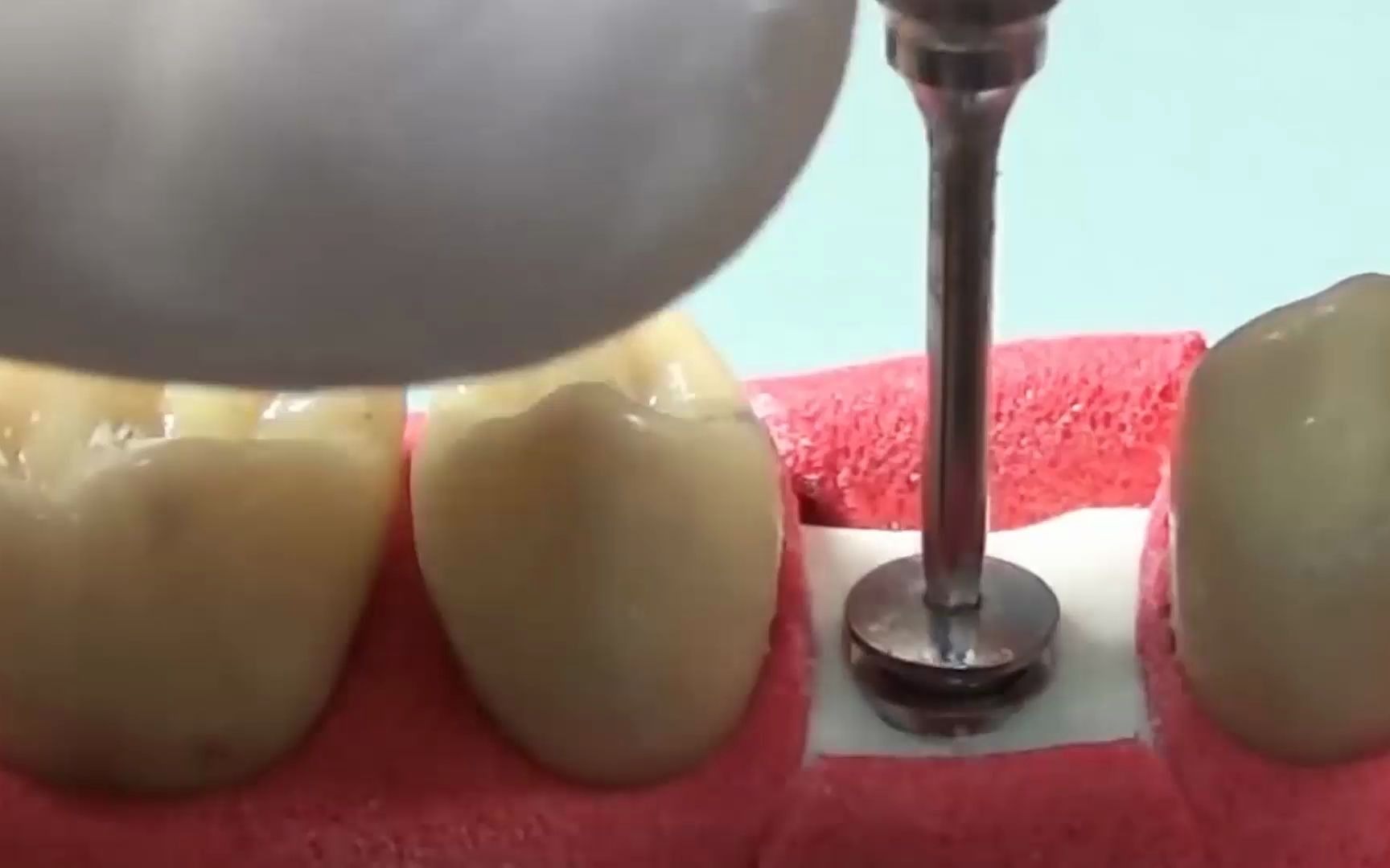 模型演示种植牙的全过程!